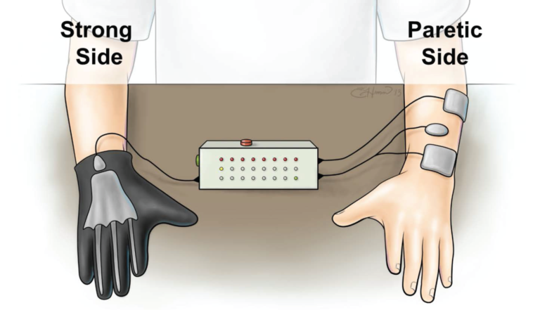 Electrical Stimulation Archives - Neurorehabdirectory ...