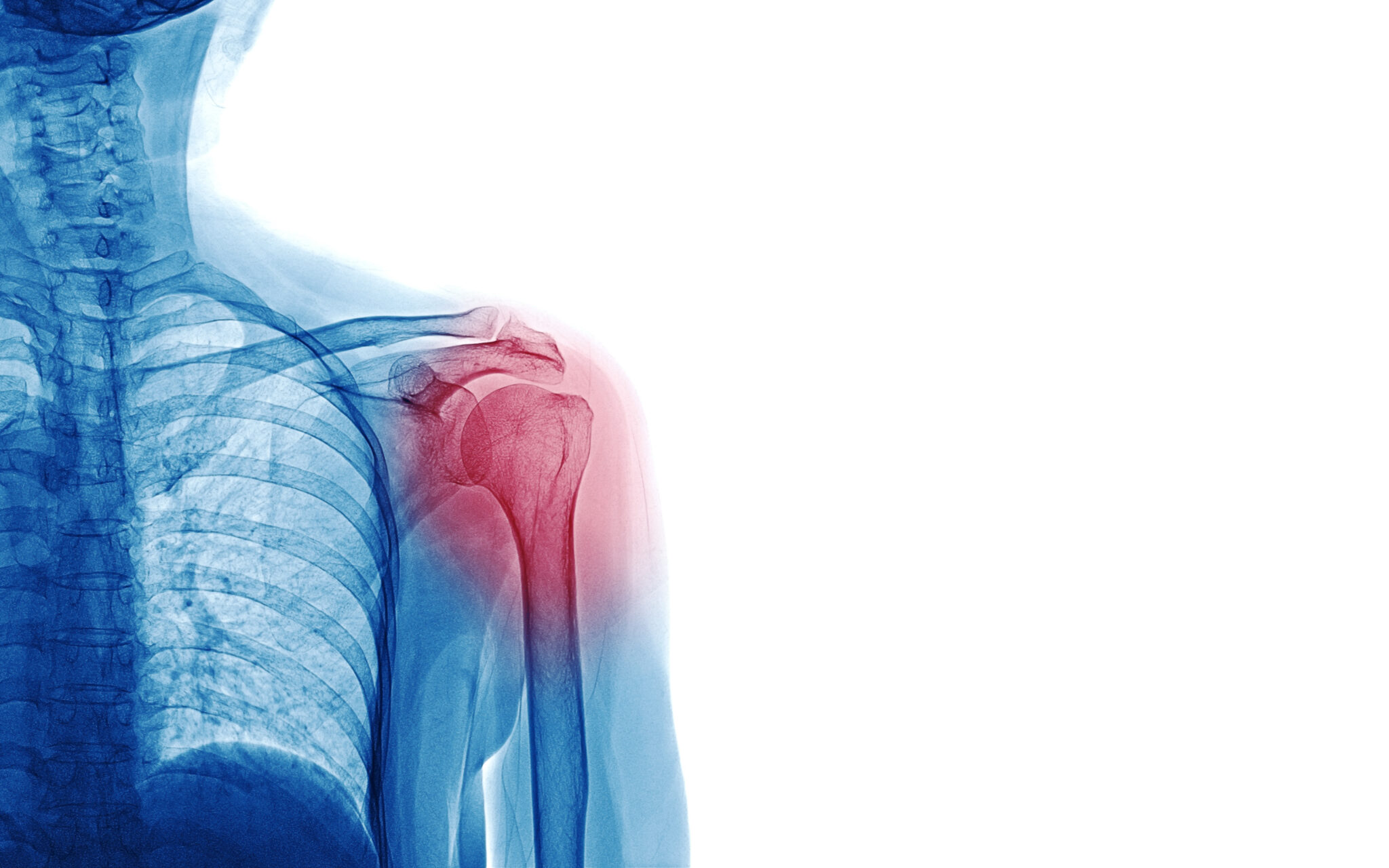 Stroke Shoulder Online CEU Course Now Available - Neurorehabdirectory ...
